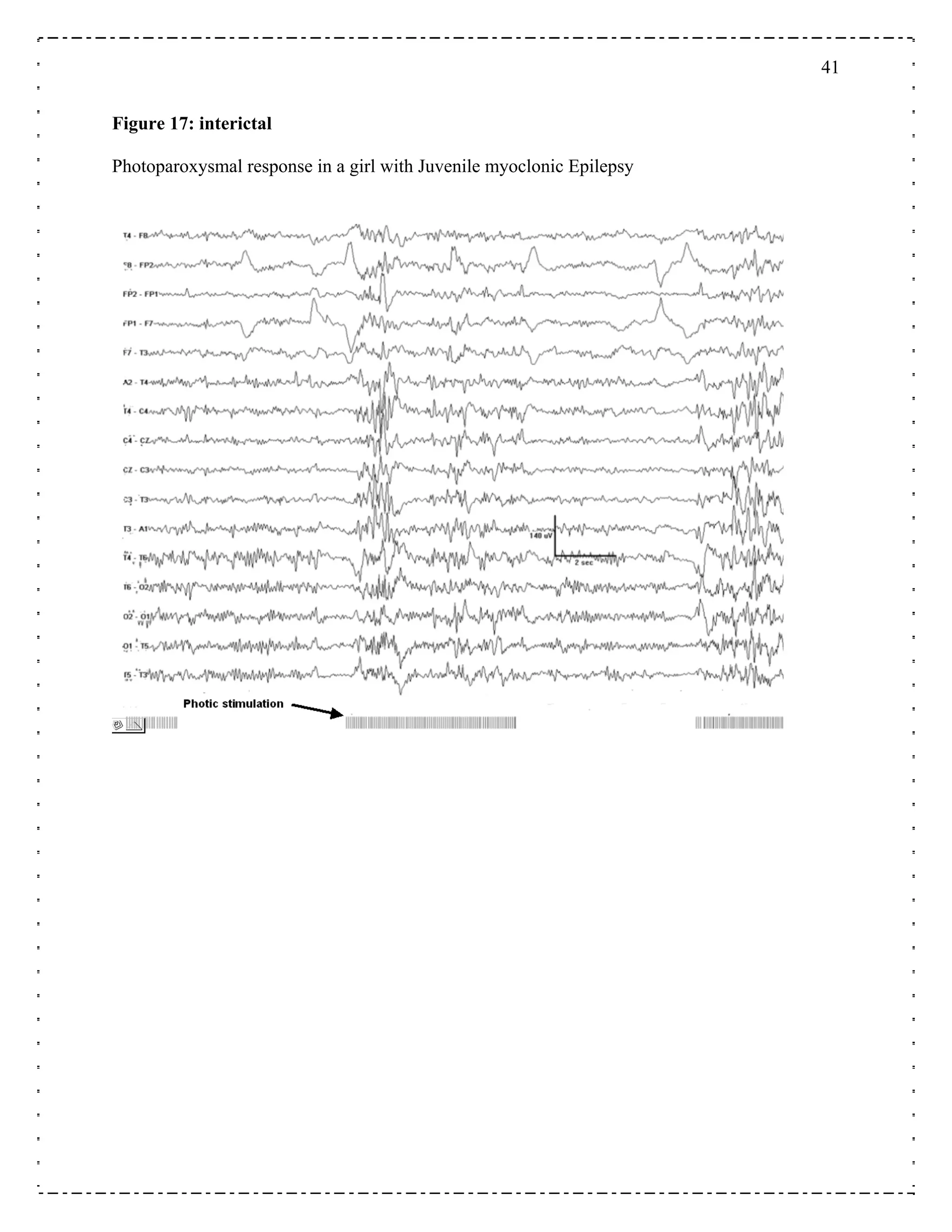 Pediatric EEG - by Dr.Rajesh Ramachandran Nair | PDF