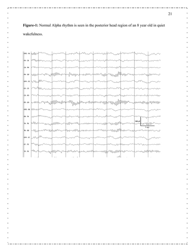 Pediatric EEG - by Dr.Rajesh Ramachandran Nair | PDF