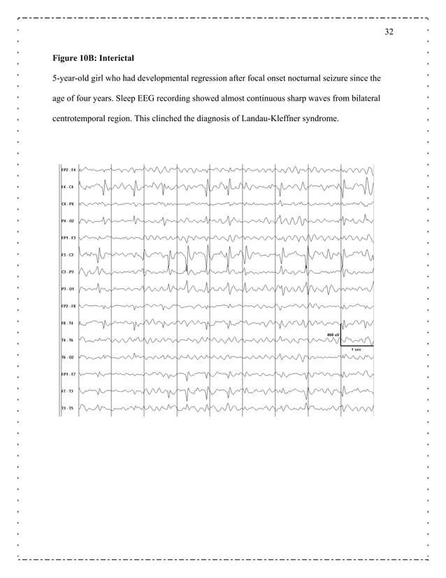 Pediatric EEG - by Dr.Rajesh Ramachandran Nair | PDF