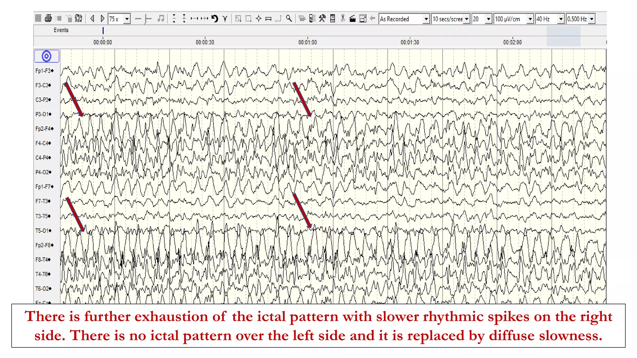 EEG in convulsive and non convulsive seizures in the intensive care ...