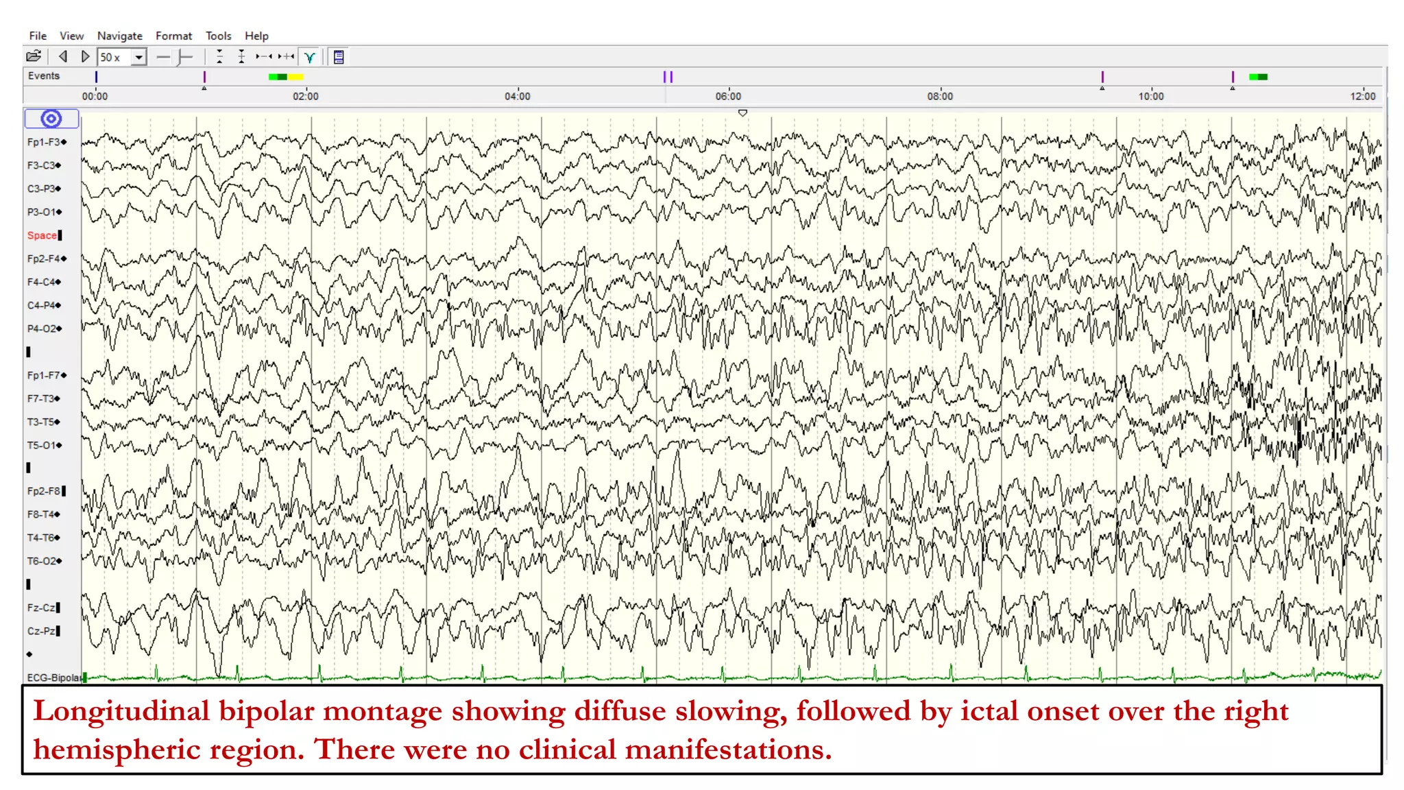 EEG in convulsive and non convulsive seizures in the intensive care ...