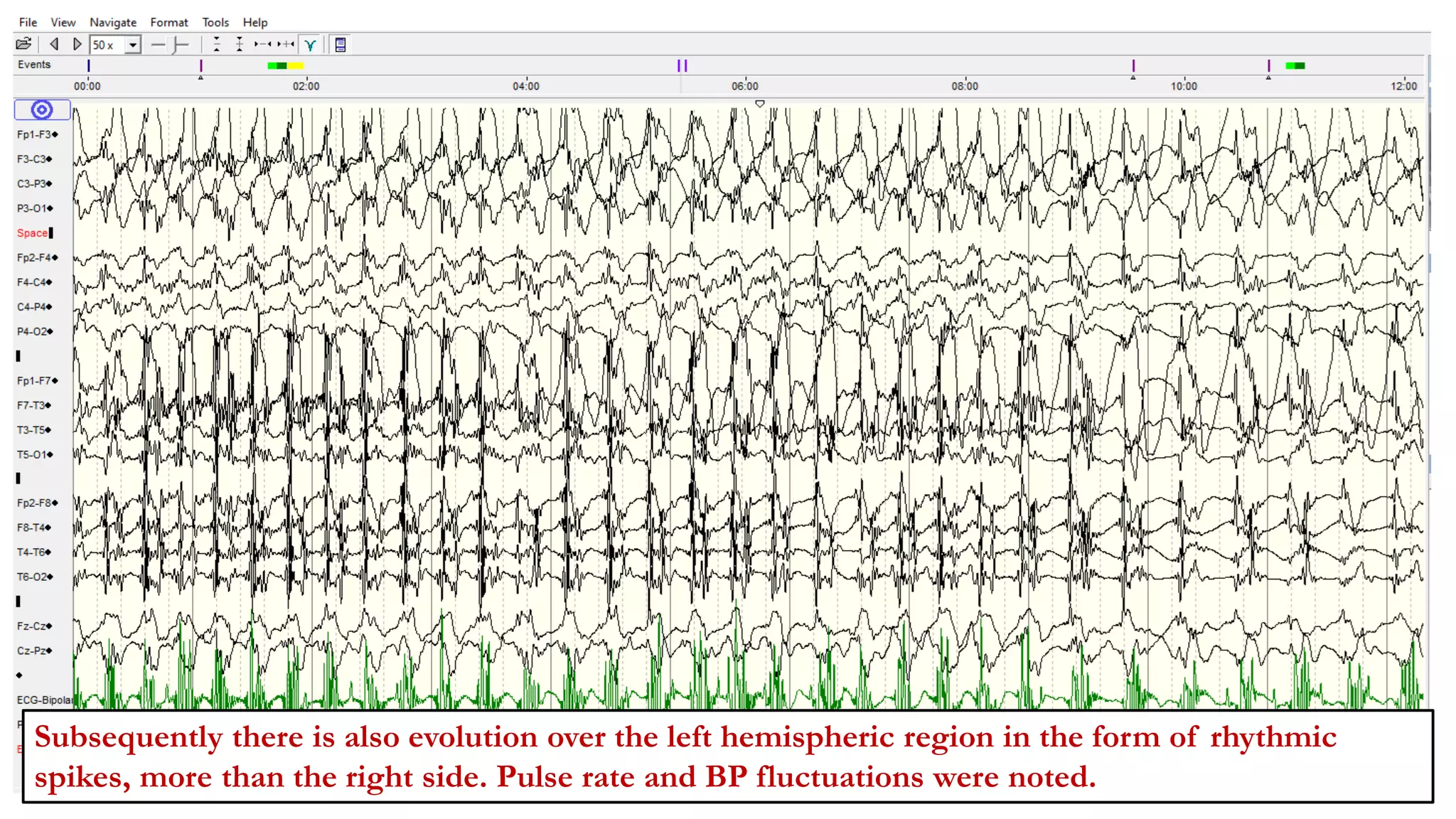 EEG in convulsive and non convulsive seizures in the intensive care ...