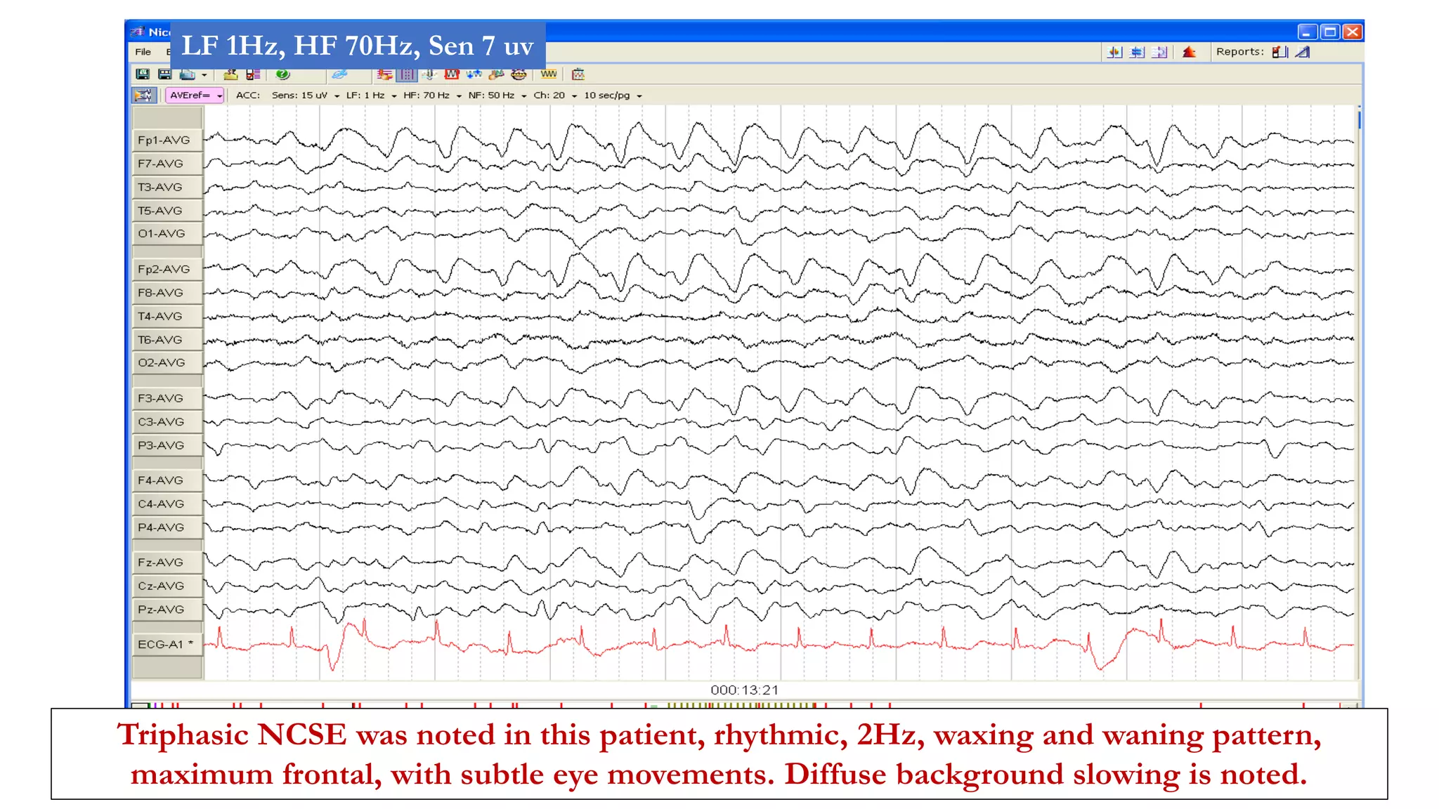 EEG in convulsive and non convulsive seizures in the intensive care ...