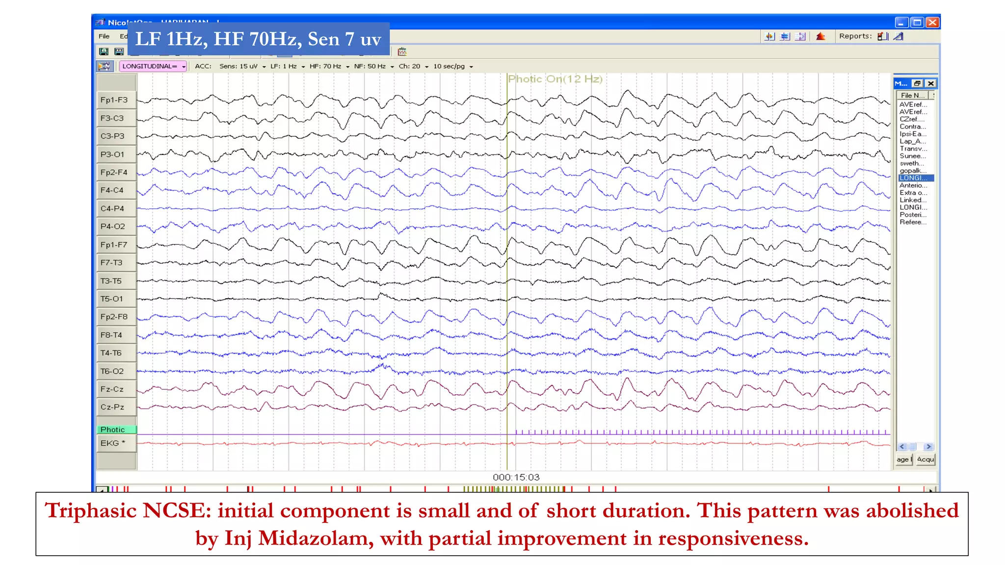 EEG in convulsive and non convulsive seizures in the intensive care ...
