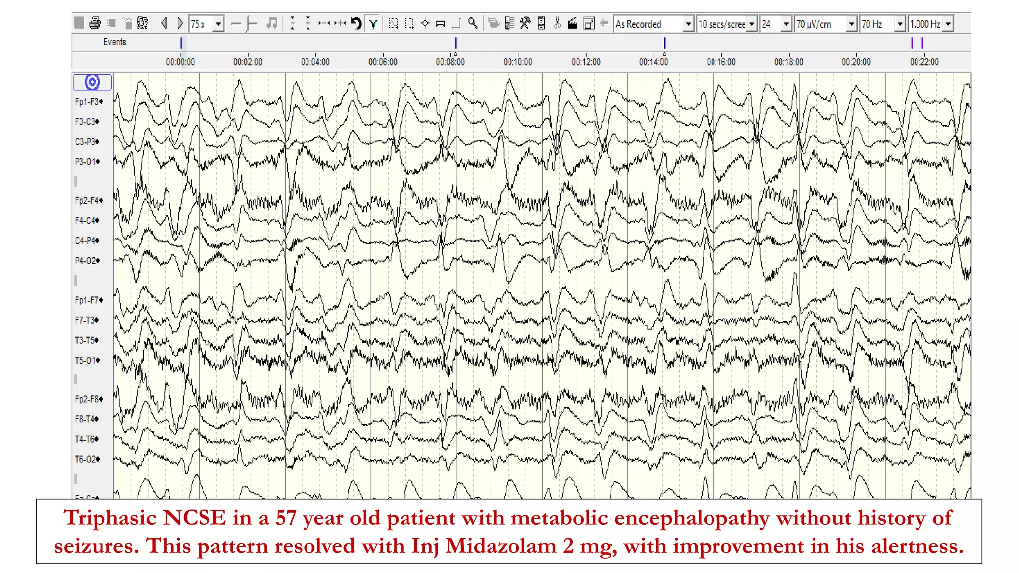 EEG in convulsive and non convulsive seizures in the intensive care ...