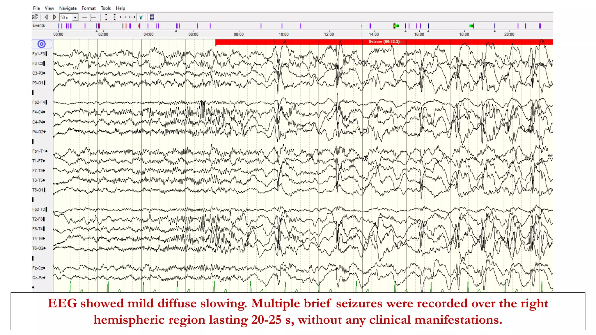 EEG in convulsive and non convulsive seizures in the intensive care ...