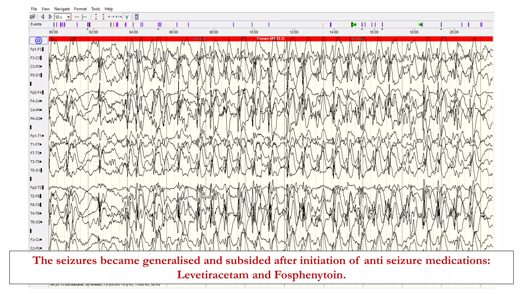 EEG in convulsive and non convulsive seizures in the intensive care ...