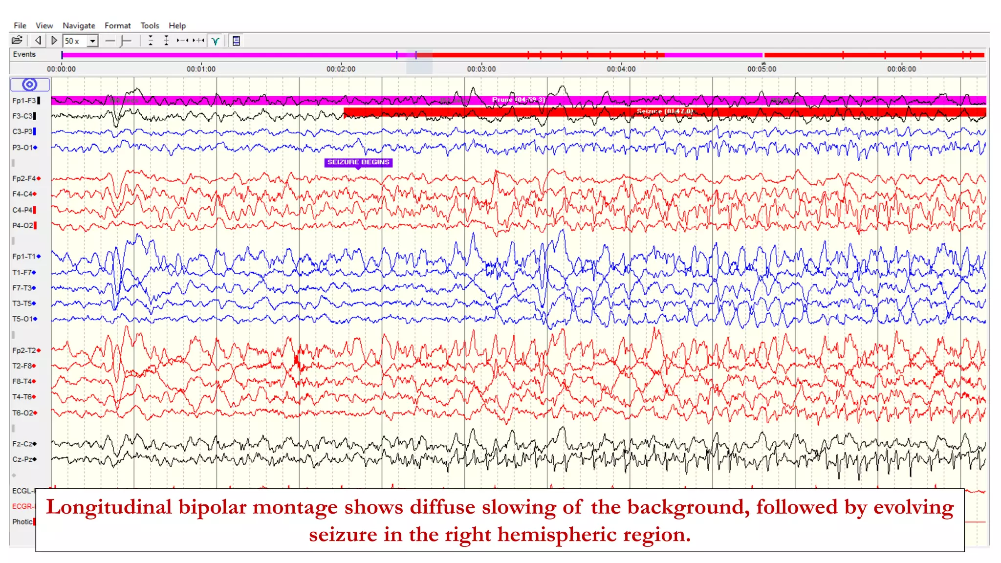 EEG in convulsive and non convulsive seizures in the intensive care ...