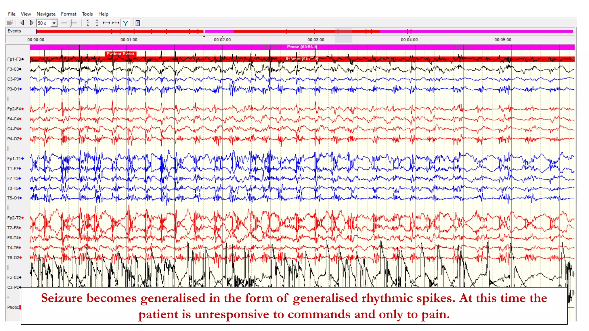 EEG in convulsive and non convulsive seizures in the intensive care ...