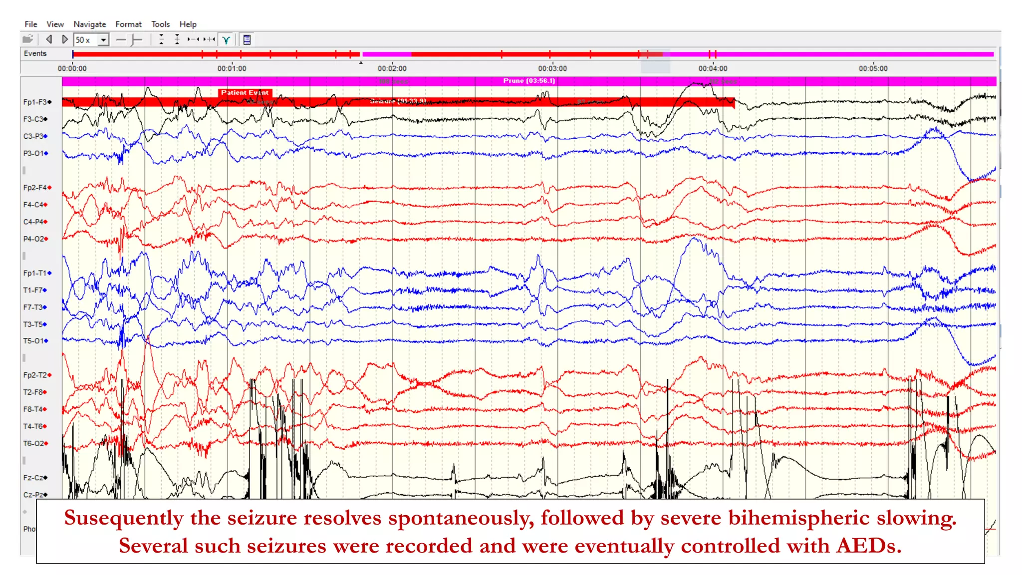 EEG in convulsive and non convulsive seizures in the intensive care ...