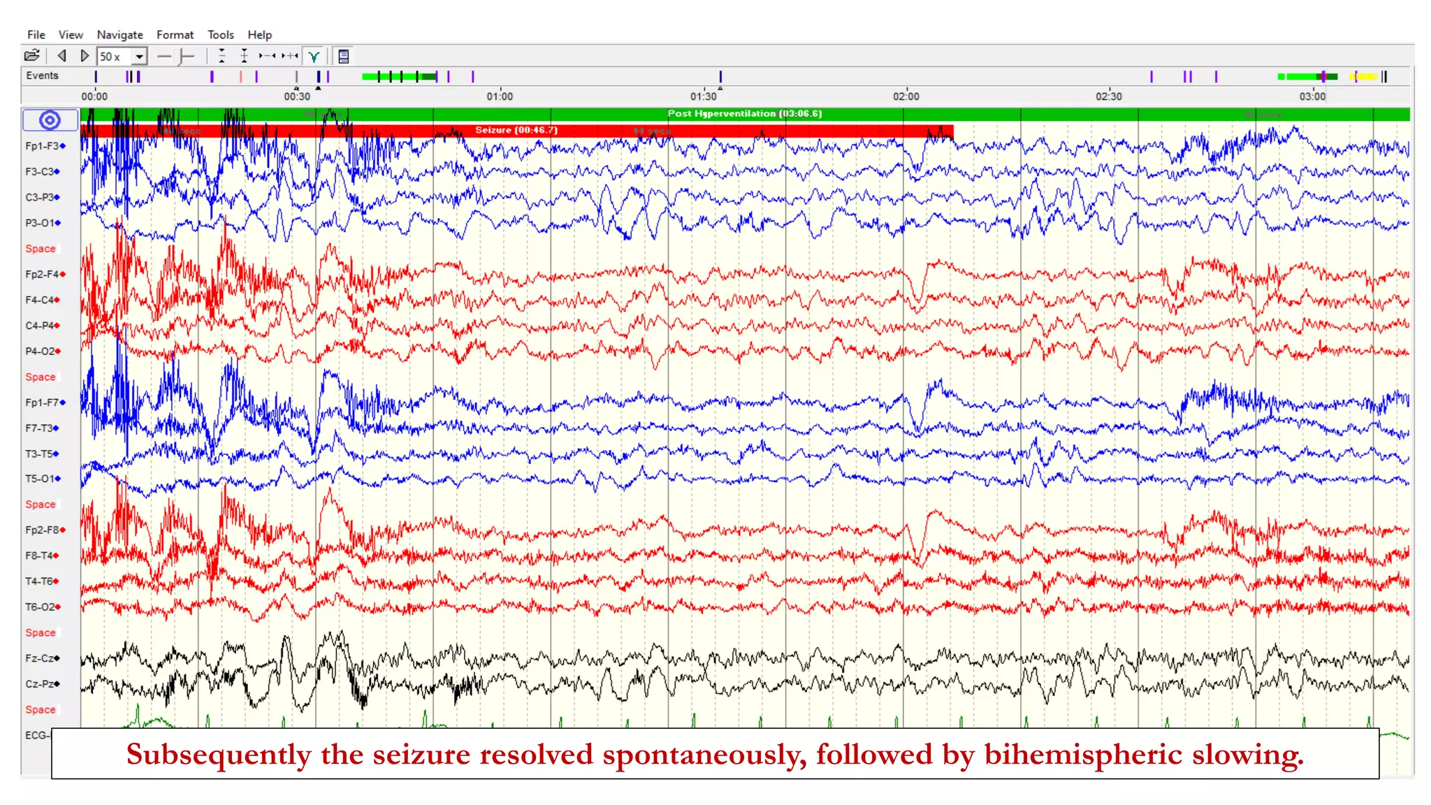 EEG in convulsive and non convulsive seizures in the intensive care ...
