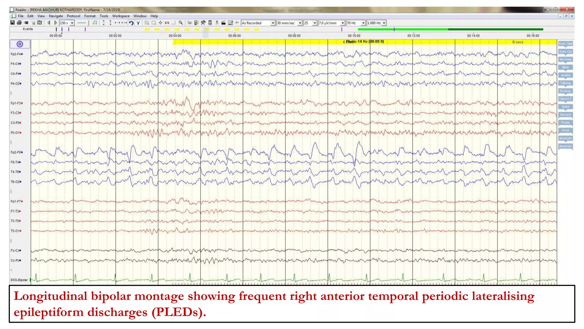 EEG in convulsive and non convulsive seizures in the intensive care ...