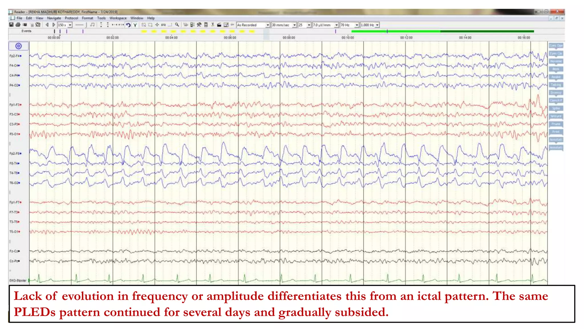 EEG in convulsive and non convulsive seizures in the intensive care ...