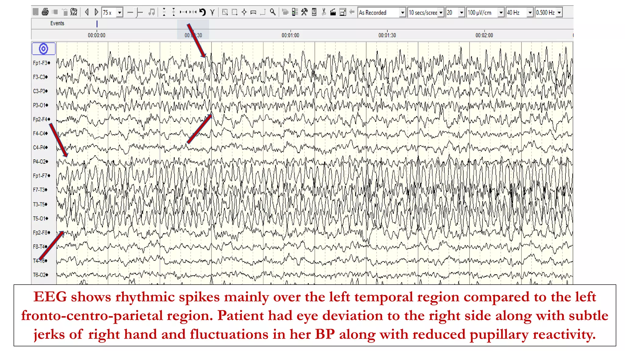 EEG in convulsive and non convulsive seizures in the intensive care unit | PPTX