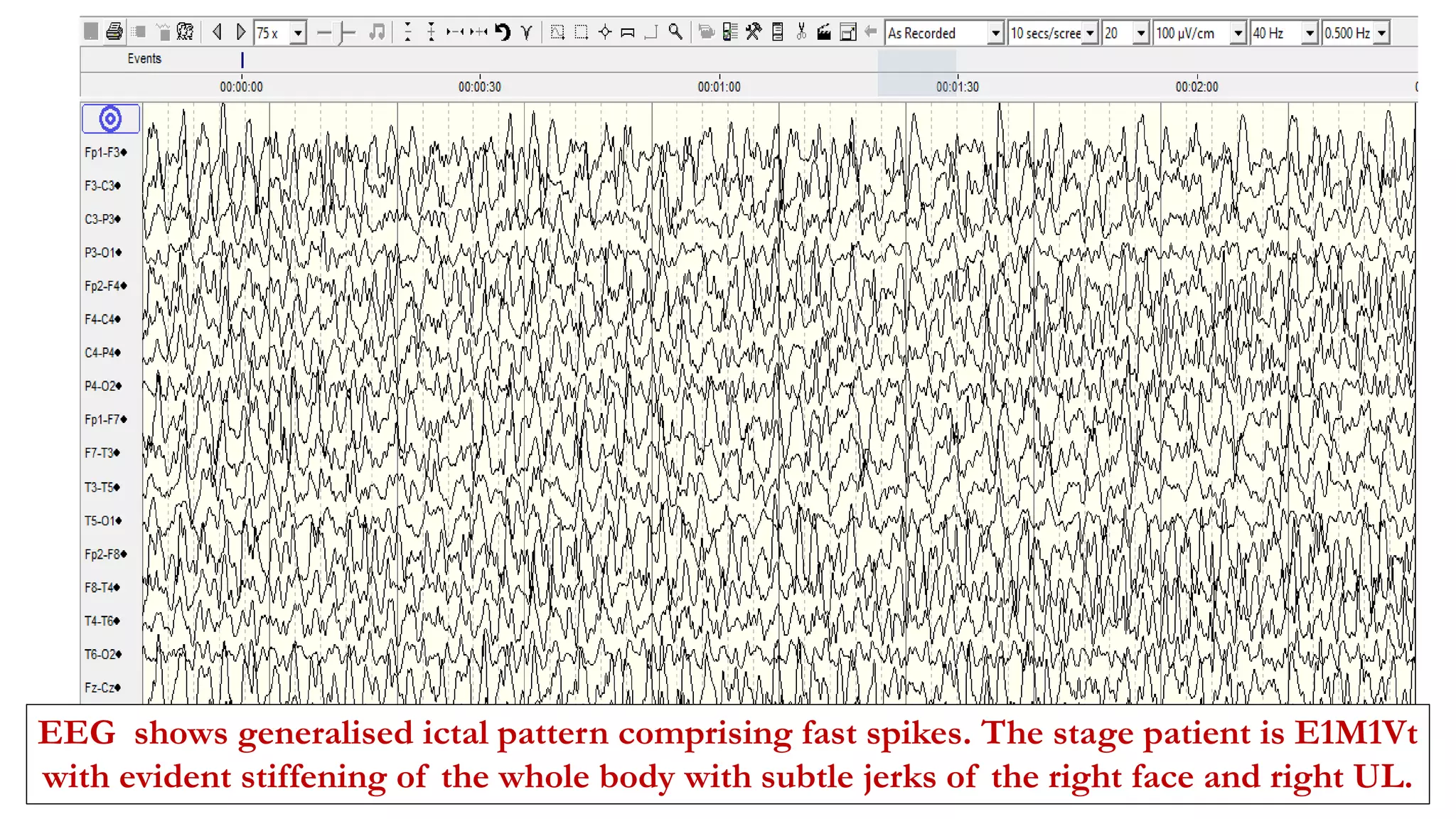 EEG in convulsive and non convulsive seizures in the intensive care ...