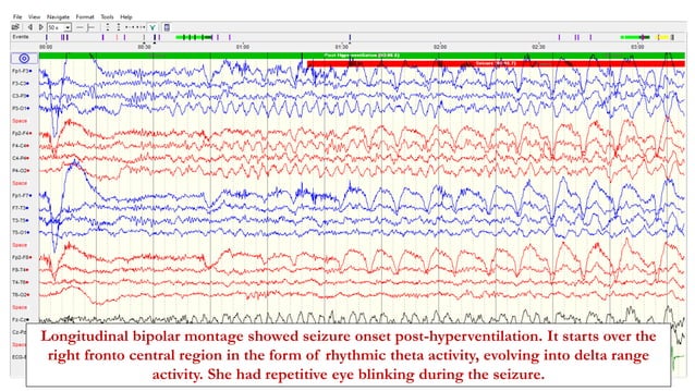 EEG in convulsive and non convulsive seizures in the intensive care ...