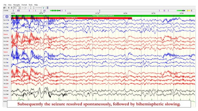EEG in convulsive and non convulsive seizures in the intensive care ...