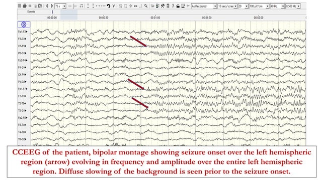 EEG in convulsive and non convulsive seizures in the intensive care ...