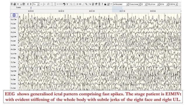 EEG in convulsive and non convulsive seizures in the intensive care ...