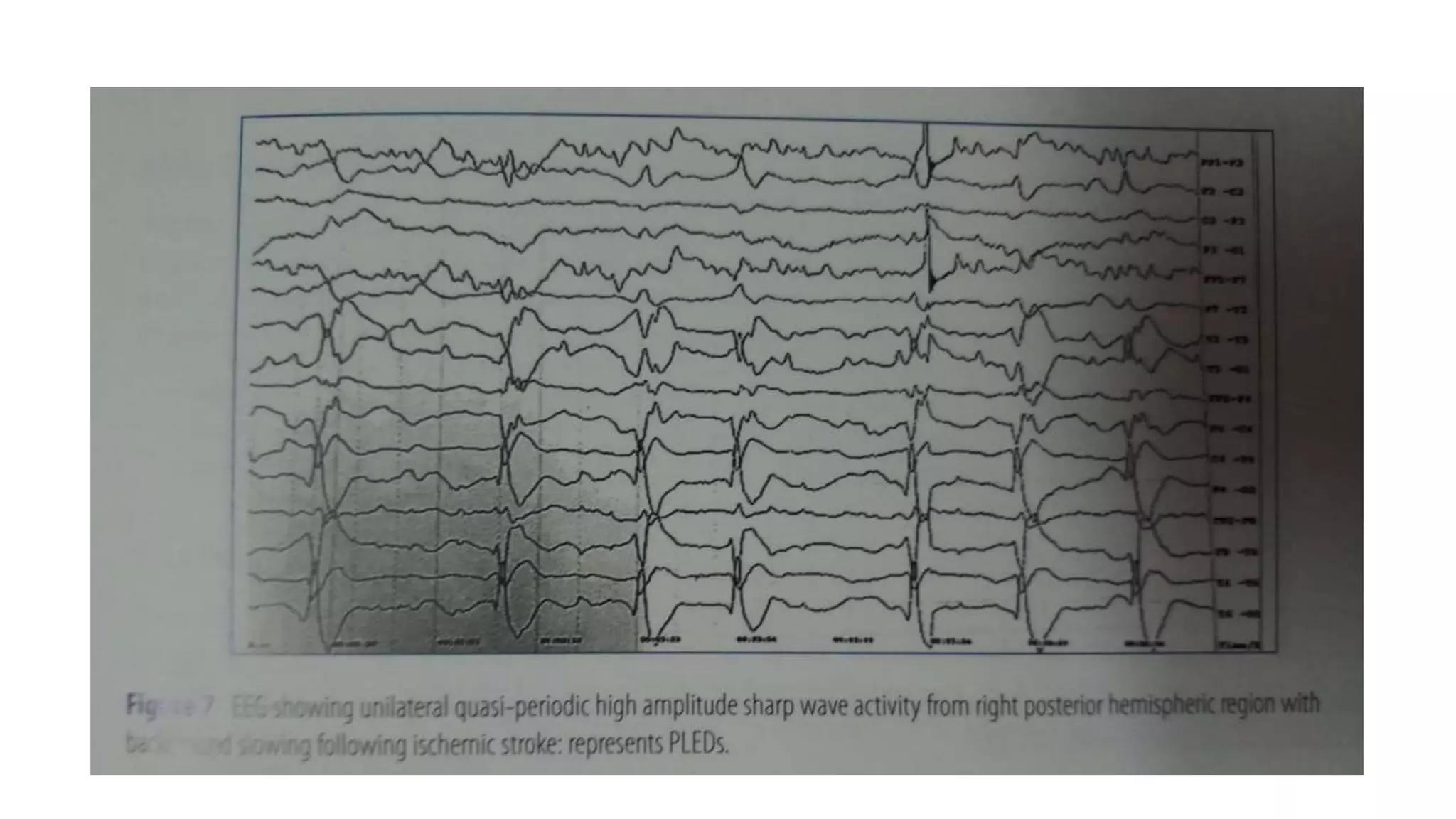 Eeg in encephalopathy | PPTX