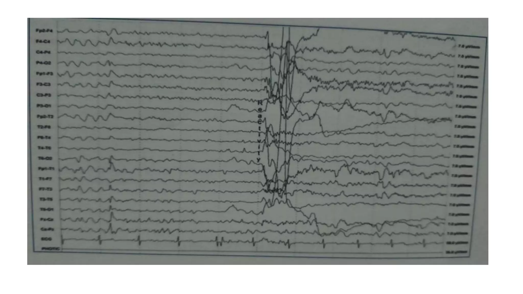 Eeg in encephalopathy | PPTX
