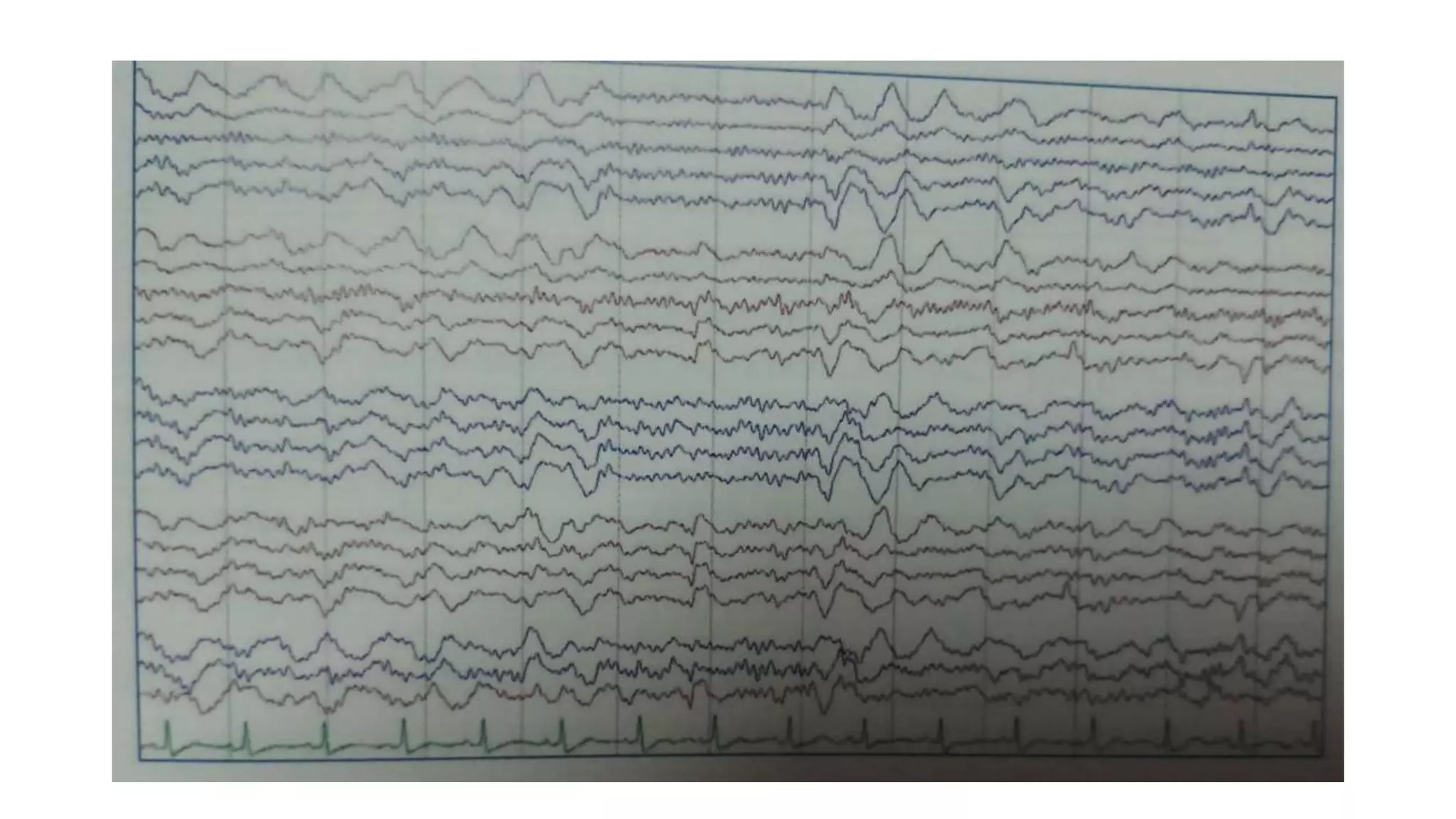 Eeg In Encephalopathy Pptx