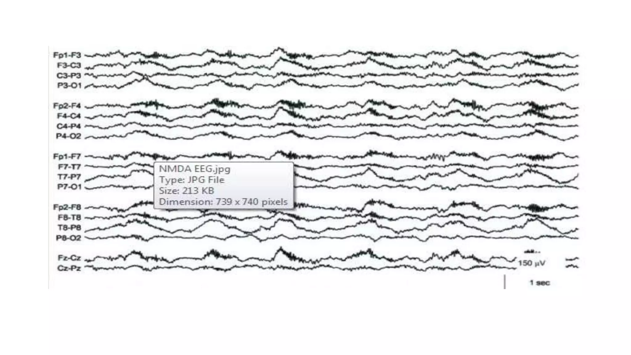 Eeg In Encephalopathy Pptx