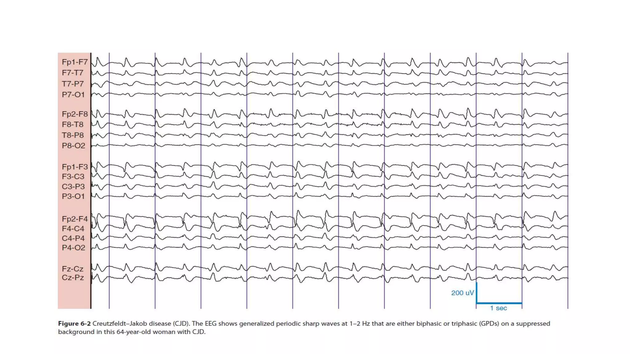 Eeg in encephalopathy | PPTX