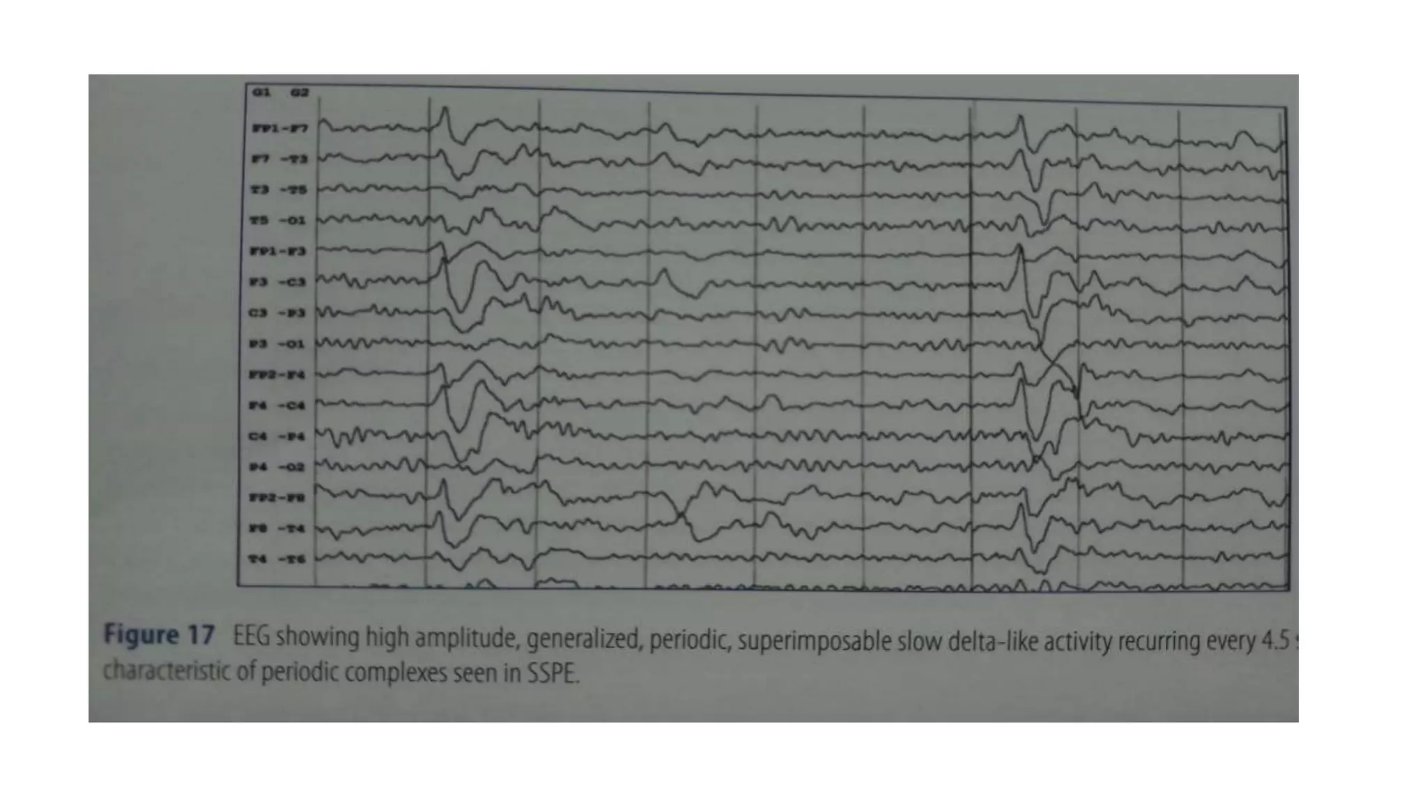 Eeg in encephalopathy | PPTX
