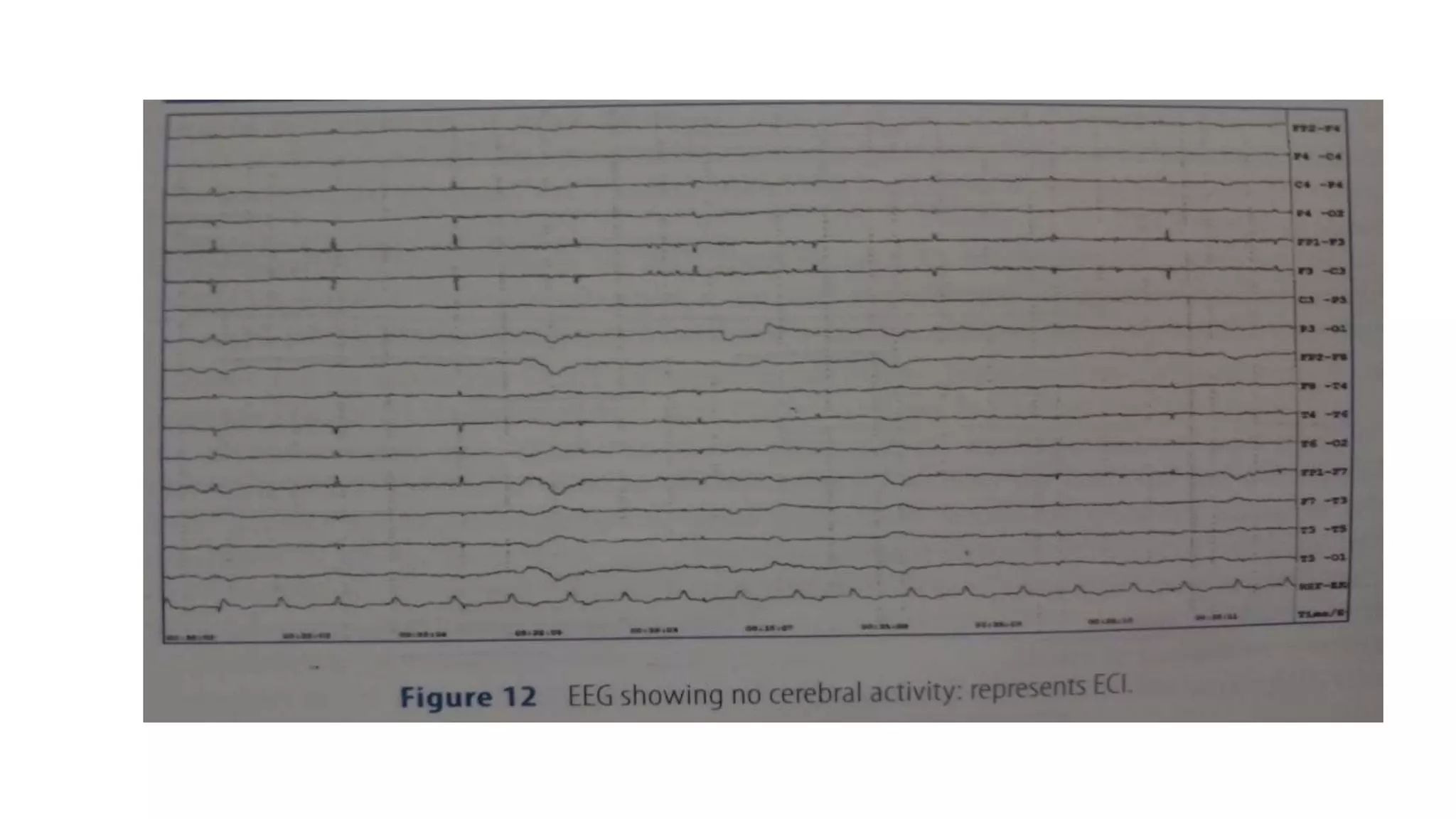 Eeg In Encephalopathy Pptx