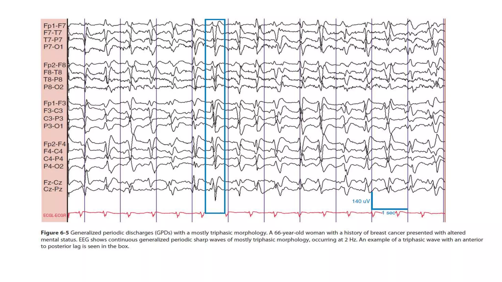 Eeg in encephalopathy | PPTX
