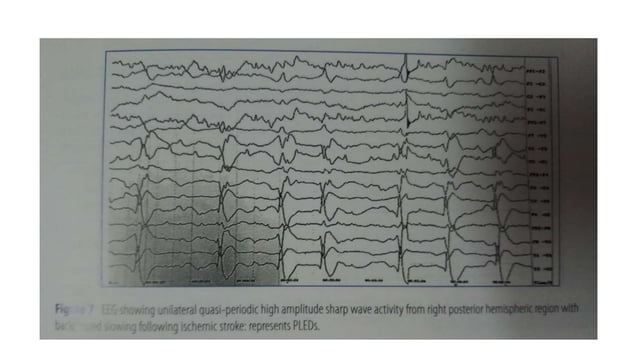 Eeg in encephalopathy | PPTX