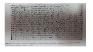 Eeg in encephalopathy | PPTX