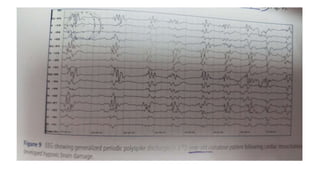 Eeg in encephalopathy | PPTX