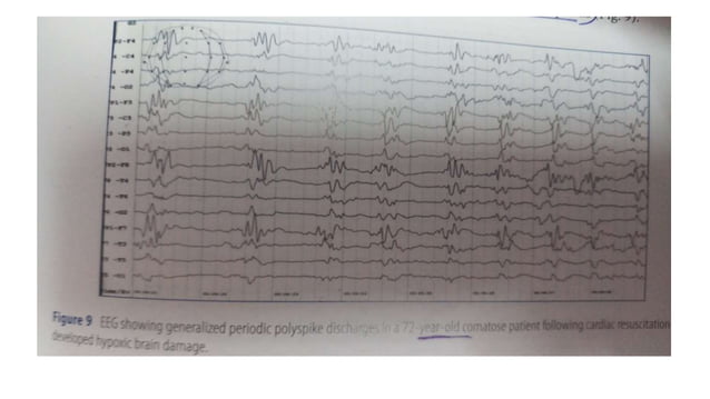 Eeg in encephalopathy | PPTX