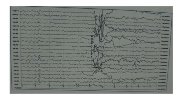 Eeg in encephalopathy | PPTX