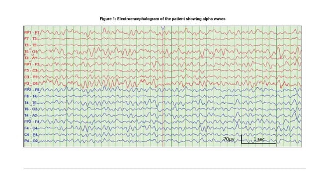 Eeg in encephalopathy | PPTX