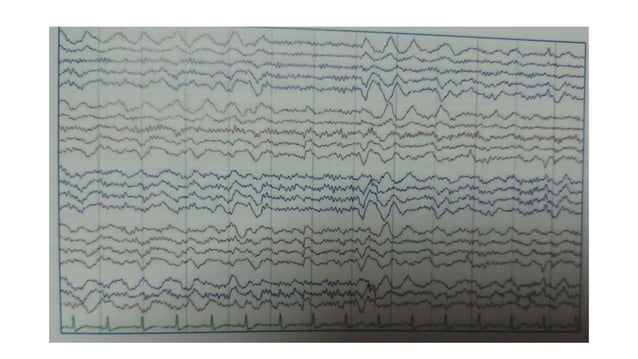 Eeg in encephalopathy | PPTX