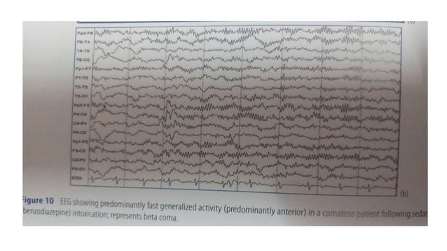 Eeg in encephalopathy | PPTX