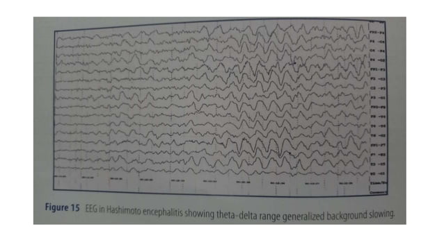 Eeg in encephalopathy | PPTX