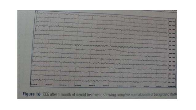 Eeg in encephalopathy | PPTX