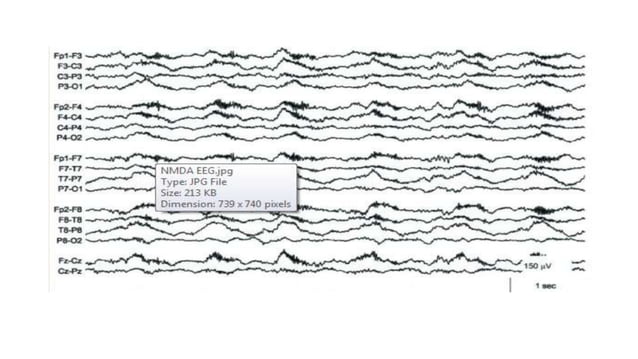 Eeg in encephalopathy | PPTX