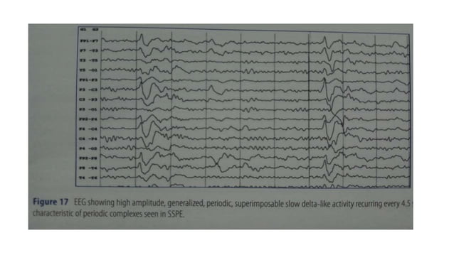 Eeg in encephalopathy | PPTX