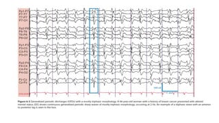 Eeg in encephalopathy | PPTX