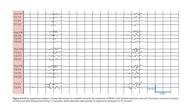 Eeg in encephalopathy | PPTX