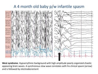 Eeg in enceplopthy | PPT