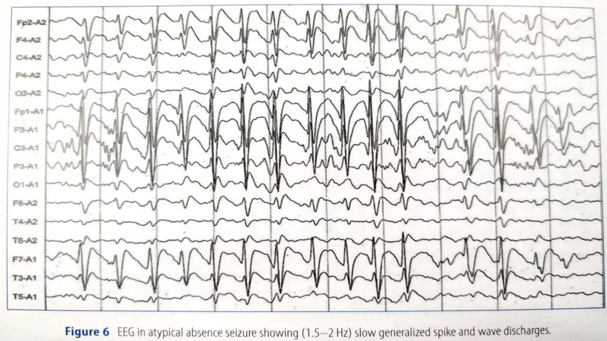 EEG in idiopathic generalised epilepsies | PPTX