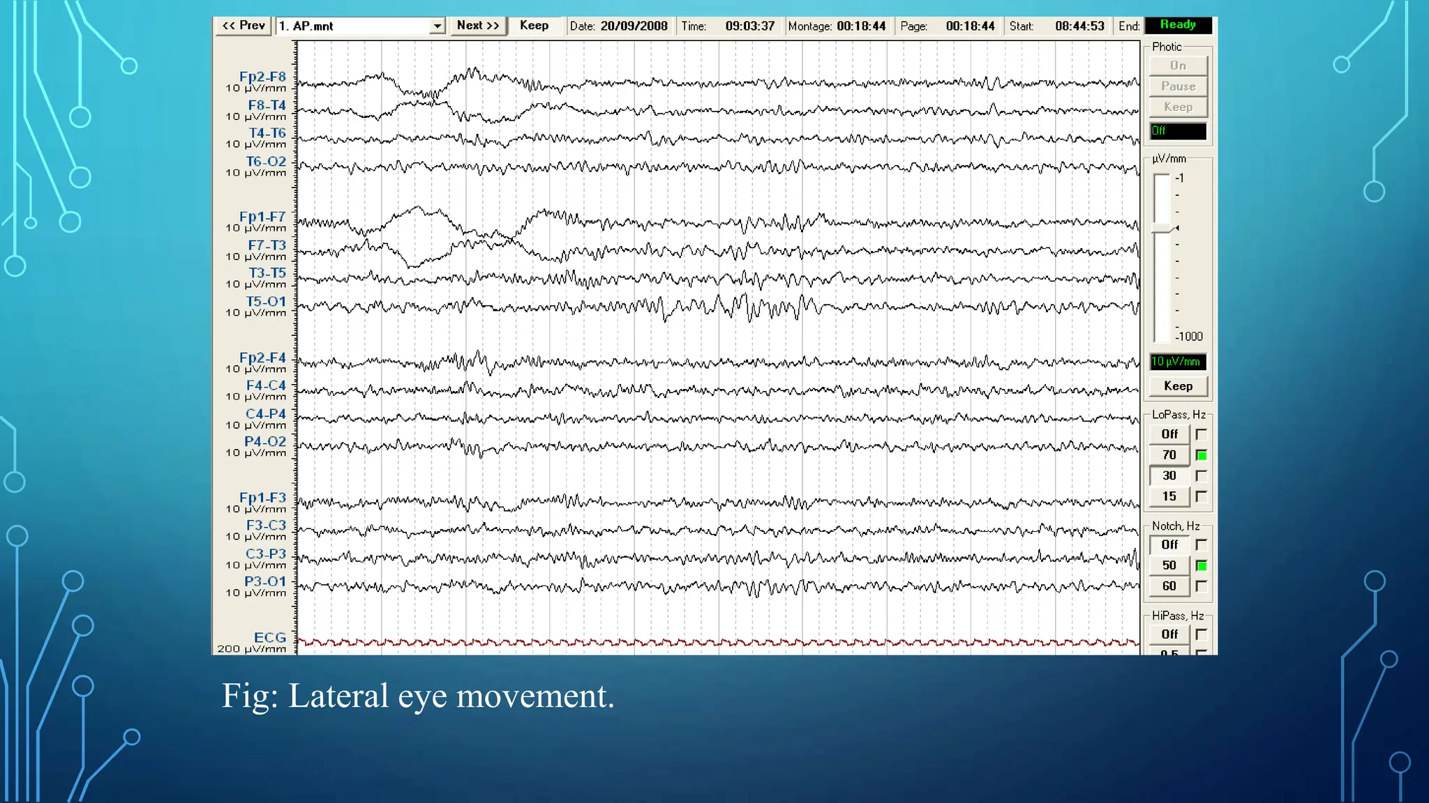 EEG Lecture 3: Artifacts and Benign EEG variants | PPTX
