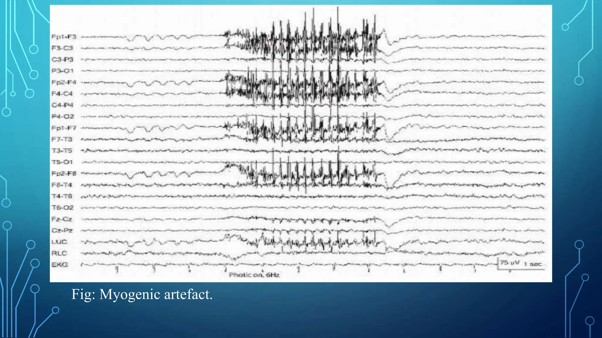 EEG Lecture 3: Artifacts and Benign EEG variants | PPTX