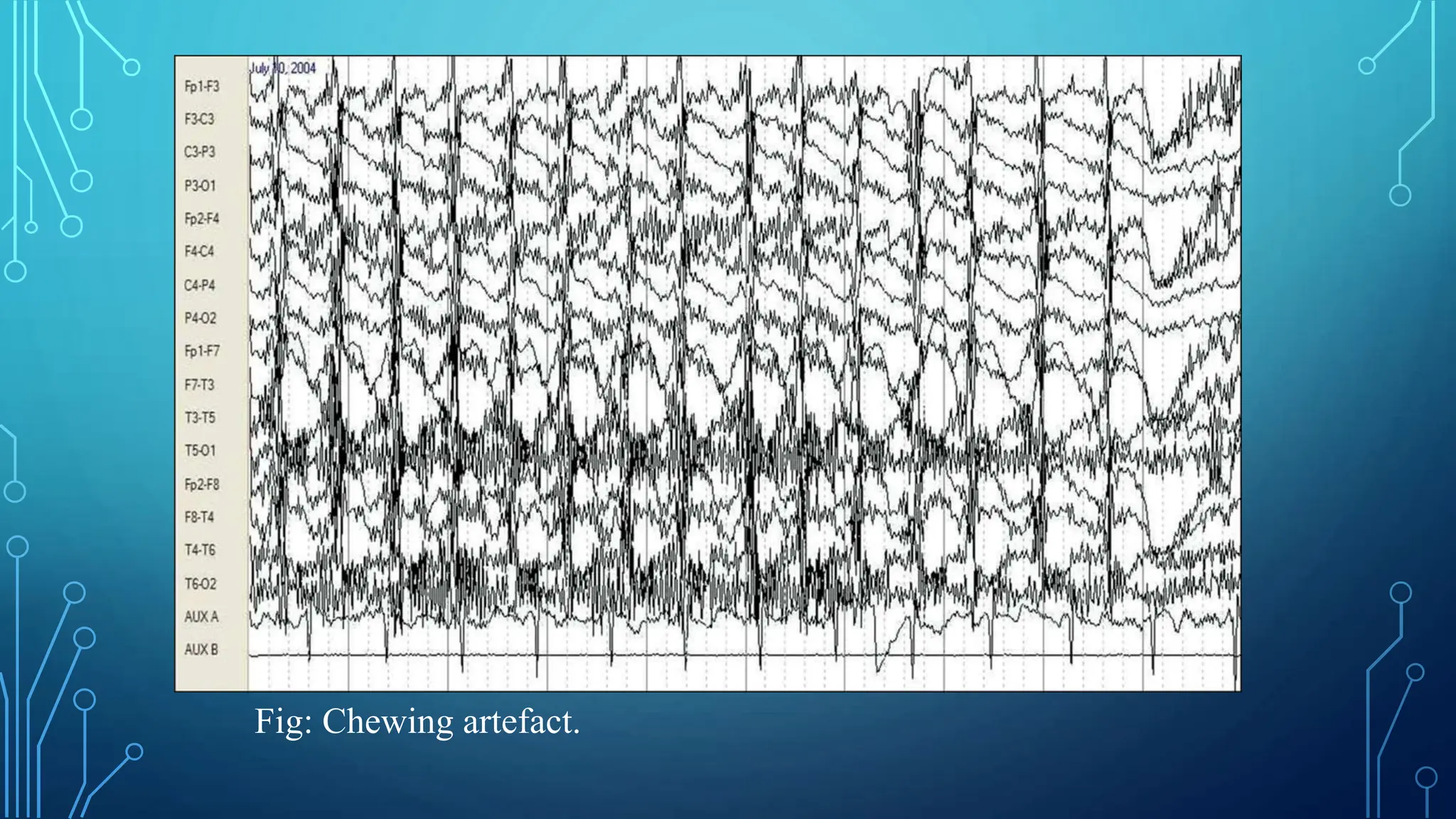 EEG Lecture 3: Artifacts and Benign EEG variants | PPTX